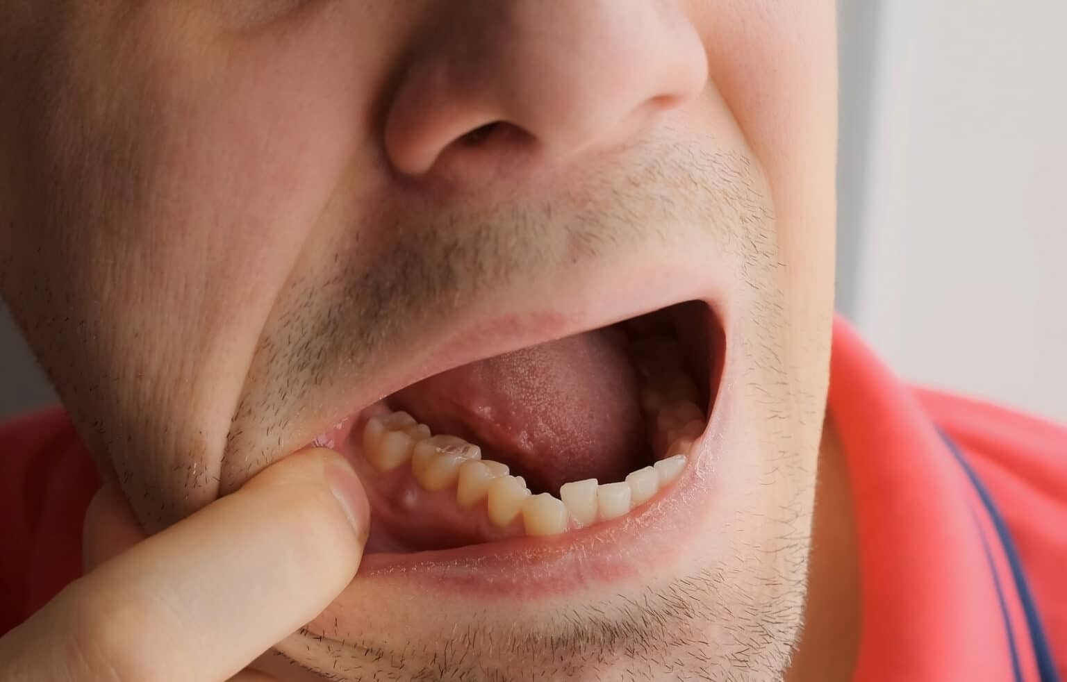 Dental Abscess - Brisbane City Dentist