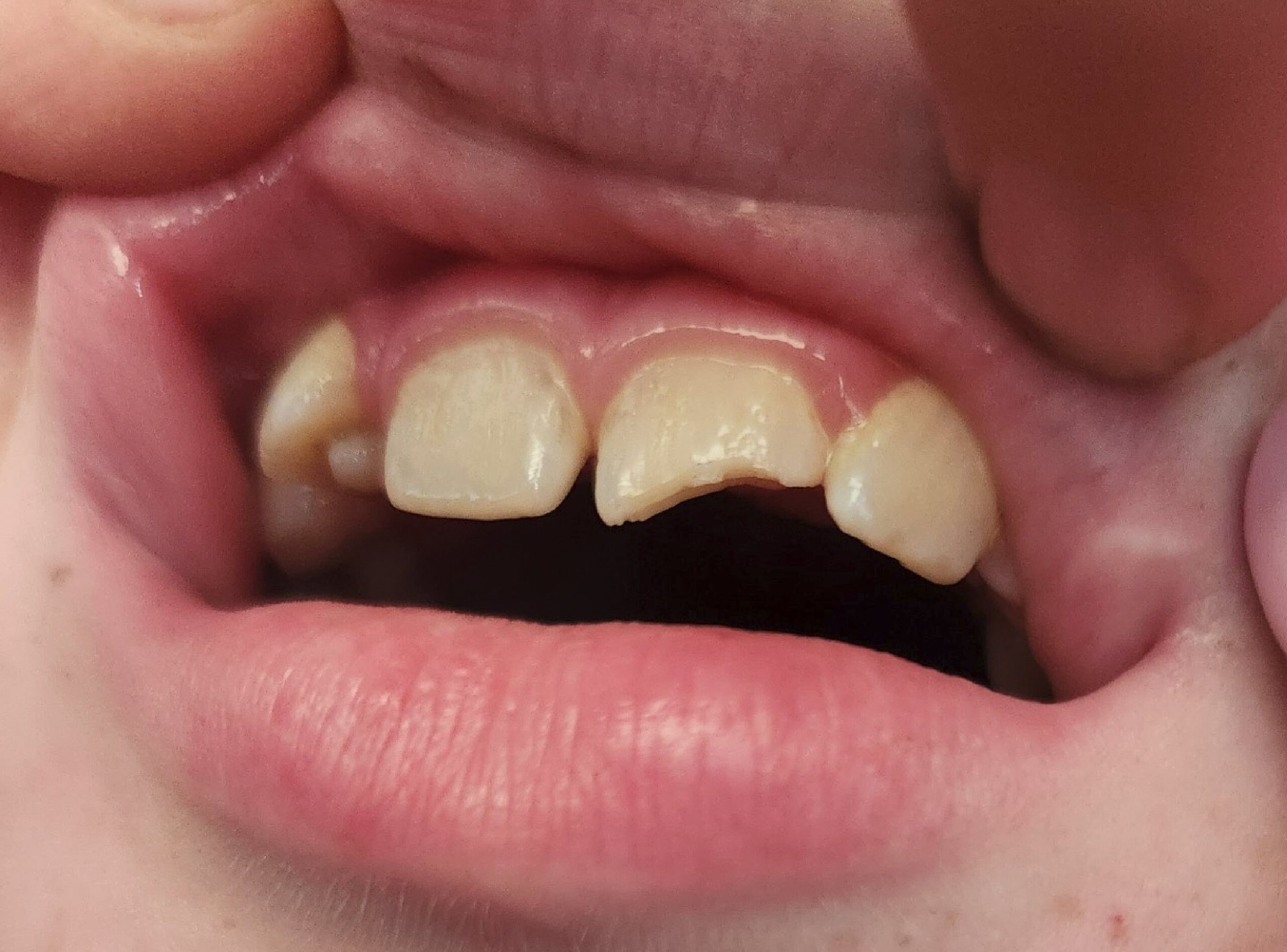 Comprehensive Dental Trauma Treatment in Brisbane: Your Ultimate Guide ...