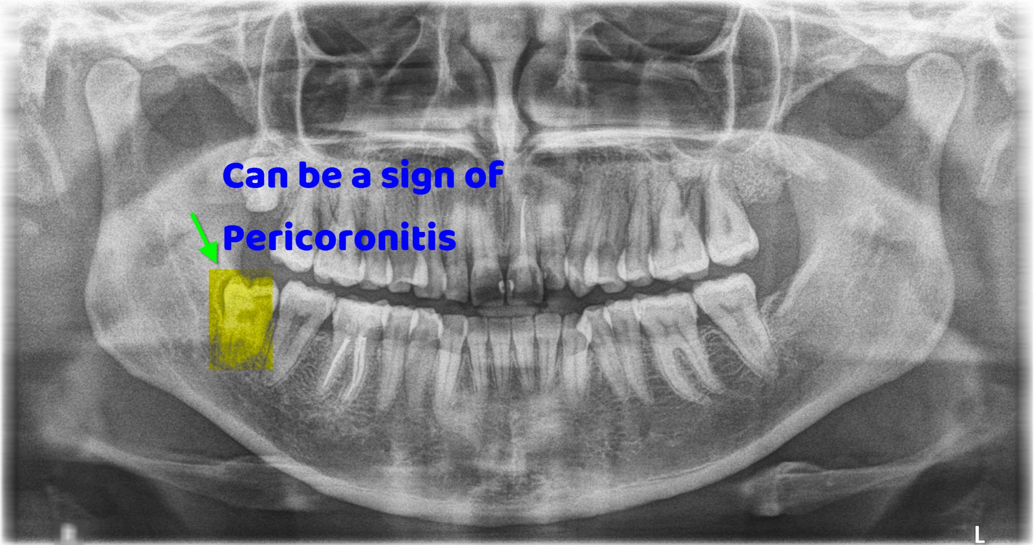 Pericoronitis - Brisbane City Dentist