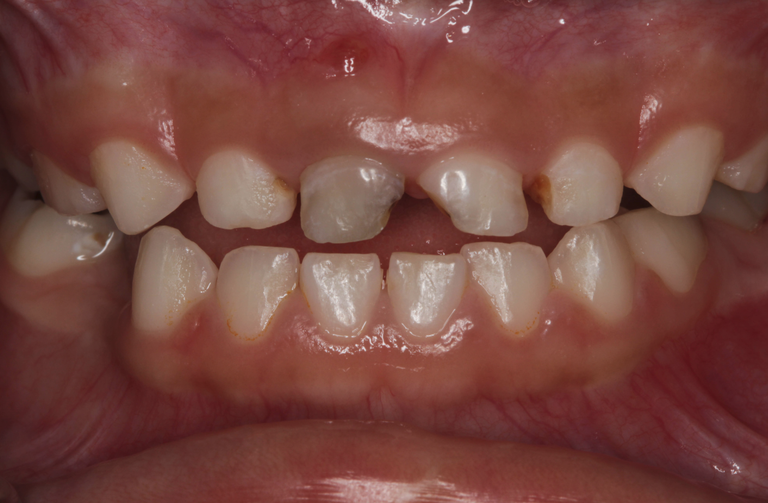 Baby Bottle Tooth Decay - Brisbane City Dentist